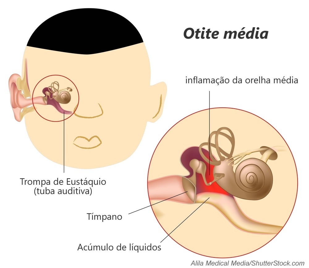 Otite Guia Do Beb Otite Guia Do Beb