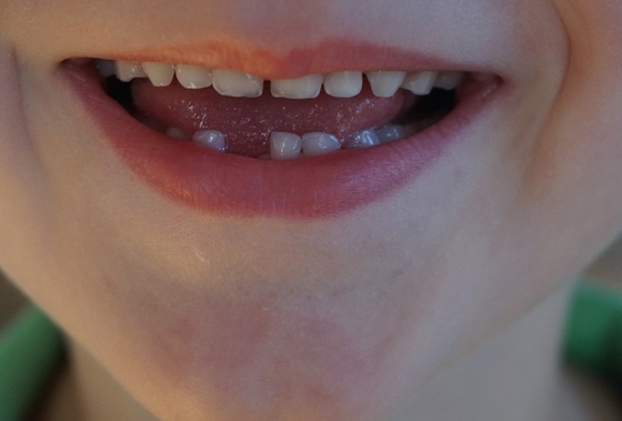 Fluorose dental – Guia do Bebê